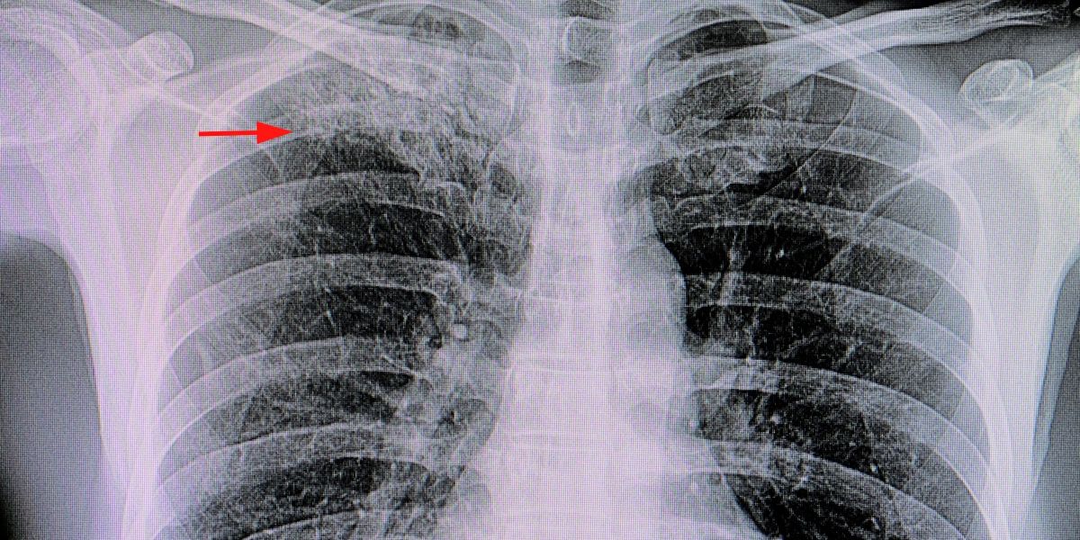 New method detects dormant bacteria that survive antibiotic treatment ...