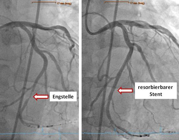 Stents aus einem Material, das sich auflöst - Gesundheit - derStandard ...
